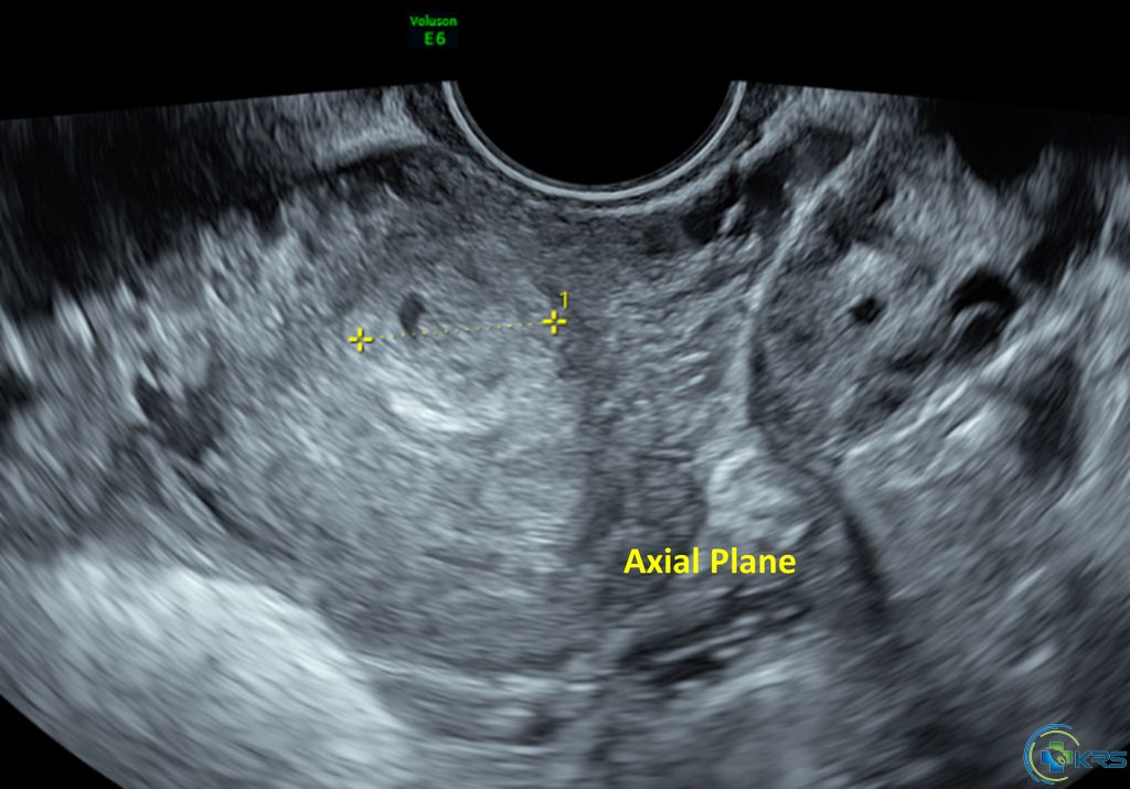 Retained Products Of Conception Drkalirajanscans Retained Products Of Conception Drkalirajanscans